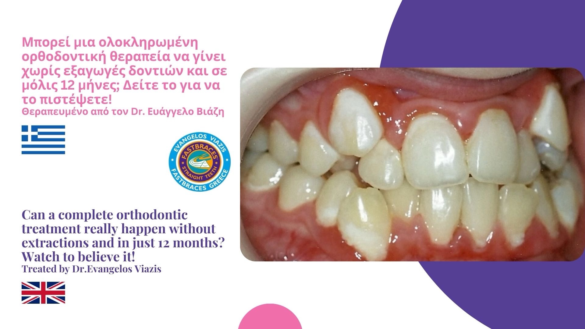 Πριν και μετά την ορθοδοντική θεραπεία - Fastbraces Greece